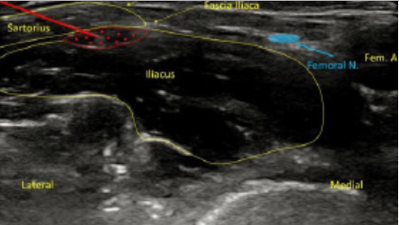 Fascia Iliaca Block — Kwak Talk