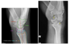Spilling the Teacup: Lunate and Perilunate Dislocations — Kwak Talk