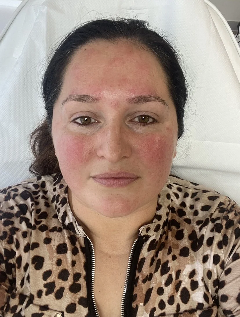 Why I Love Botulinum Toxin Injections — Kelli Clifton