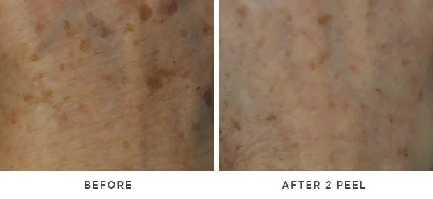 Best Chemical Peel Treatment in Wisconsin — Venustas Immortalis