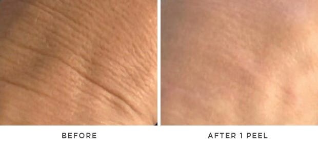 Best Chemical Peel Treatment in Wisconsin — Venustas Immortalis
