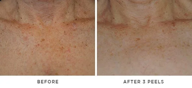 Best Chemical Peel Treatment in Wisconsin — Venustas Immortalis
