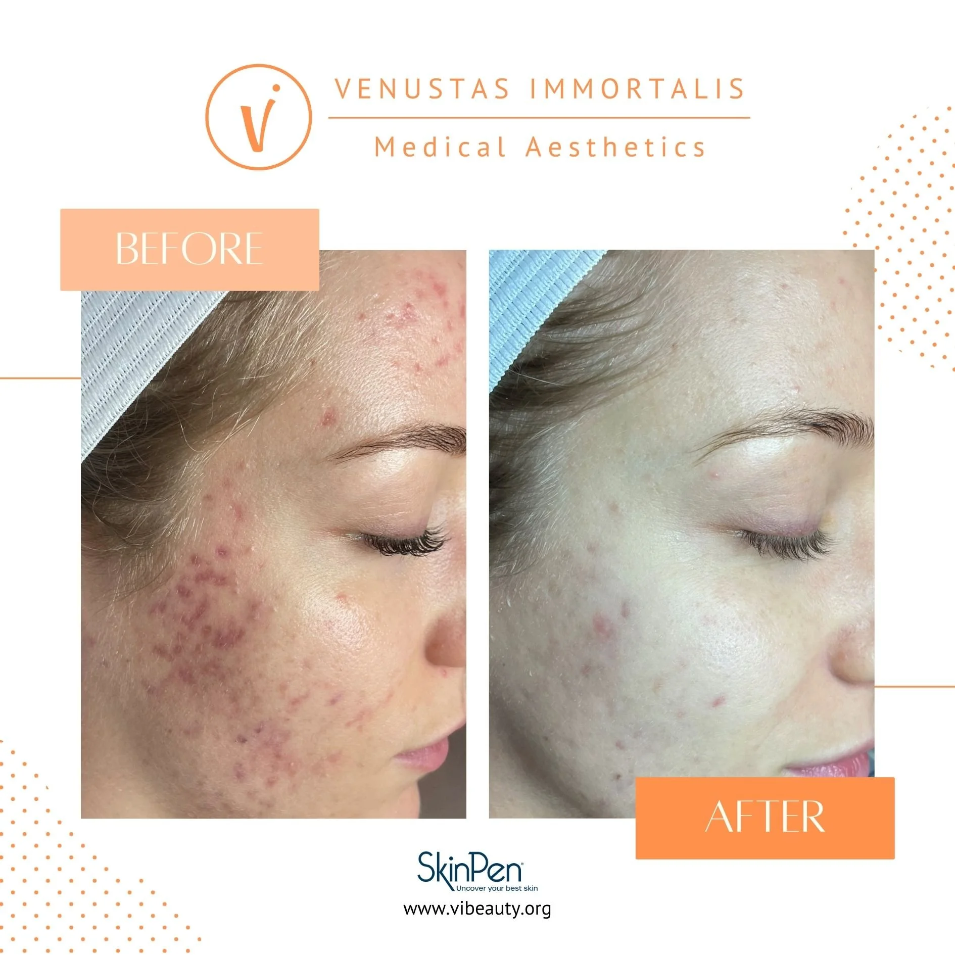 SkinPen Microneedling for Collagen Boosting | Serving Janesville, New ...