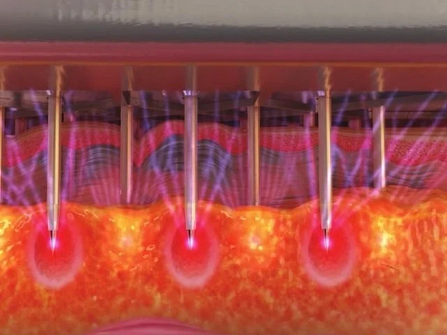 Body Contouring: TruSculpt id & Flex — Venustas Immortalis