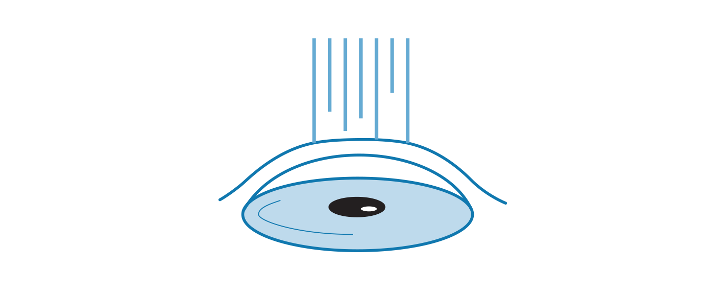 Overview of Laser Eye Treatments — QEI Laser · Laser Eye Surgery ...