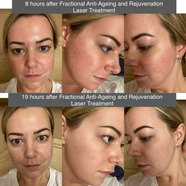Fractional Resurfacing Laser Facial Diary — Pure Emporium Skin & Laser ...