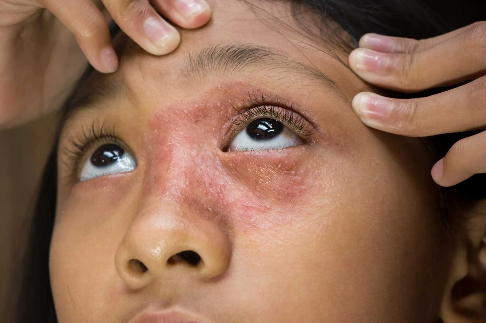 BostonSight — Dry Eye Foundation