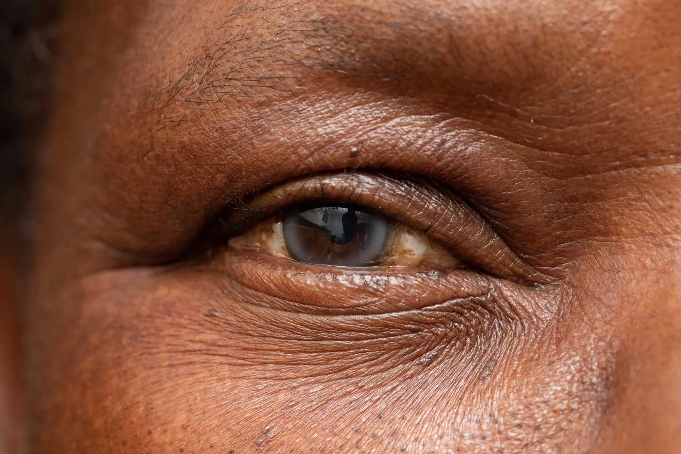 BostonSight — Dry Eye Foundation