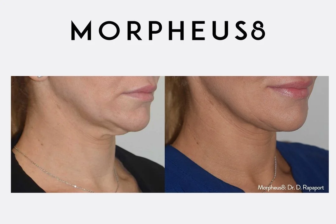 Morpheus — Vitality Kauai