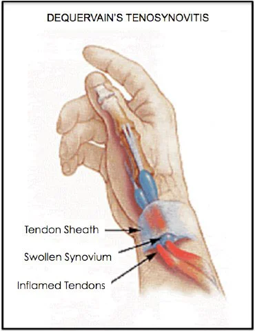 Tendonitis of Elbow, Hands and Wrist - Dr. Jonathan Lee Yi-Liang