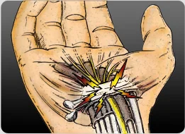 Endoscopic Carpal Tunnel Release - Dr. Jonathan Lee Yi-Liang