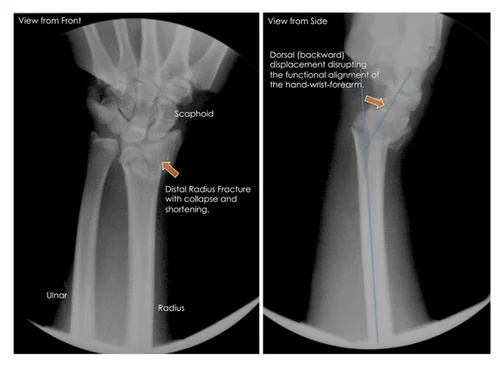 Understanding Wrist Fractures - Dr. Jonathan Lee Yi-Liang