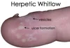 Hand Infections - Dr. Jonathan Lee Yi-Liang