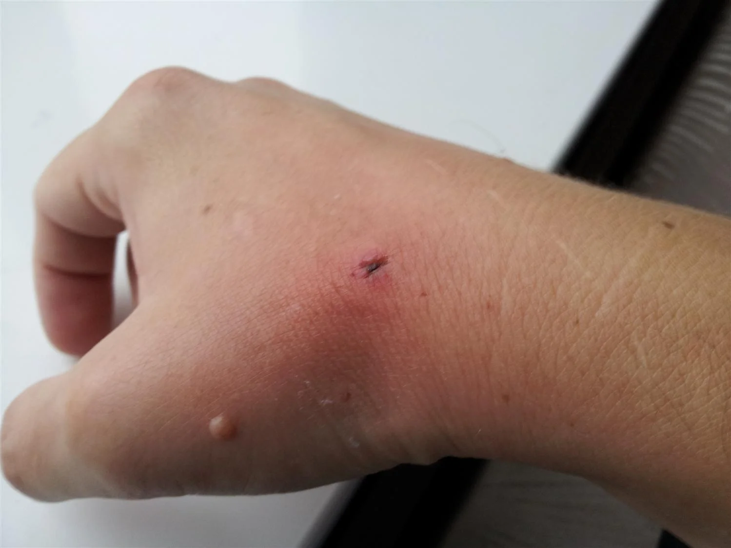 Hand Infections - Dr. Jonathan Lee Yi-Liang