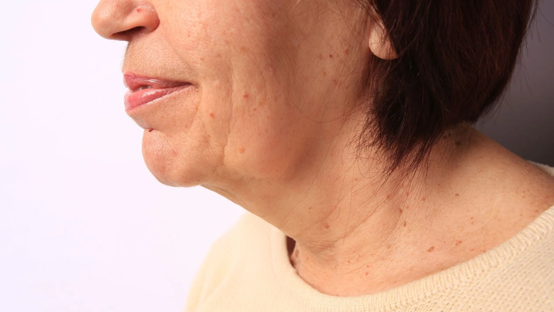 Facelifts - Benefits, Recovery and Results - Dr Rozina Ali - Award ...