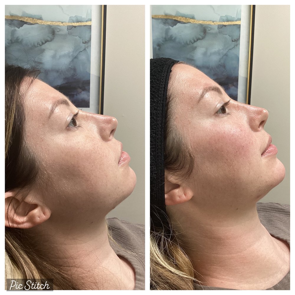 Facial Sculpting Secrets: Unveiling the Potential of Midface, Cheek ...