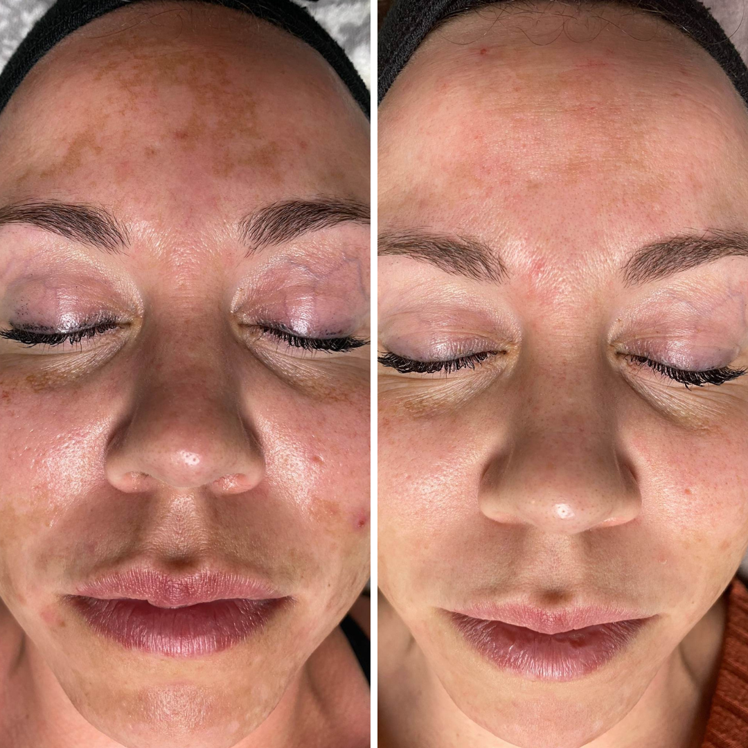 Rejuvenate Your Skin with a Microneedling Facial — Vanilla Sugar Day ...