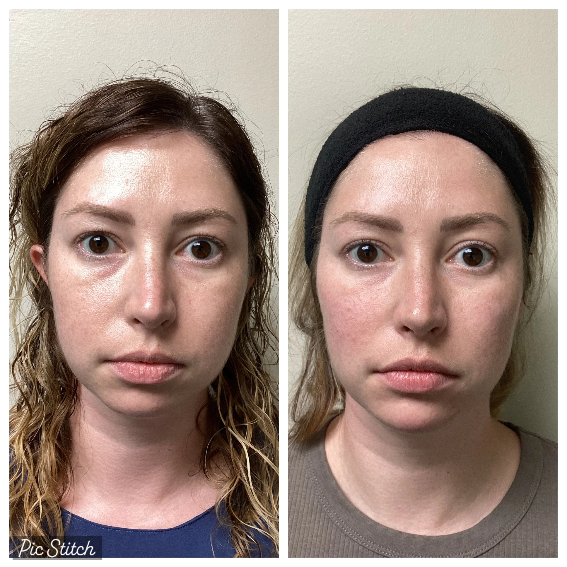 Facial Sculpting Secrets: Unveiling the Potential of Midface, Cheek ...