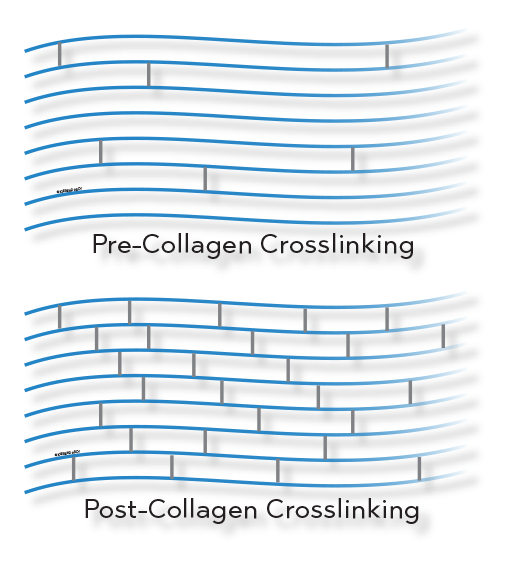 Keratoconus Cross Linking