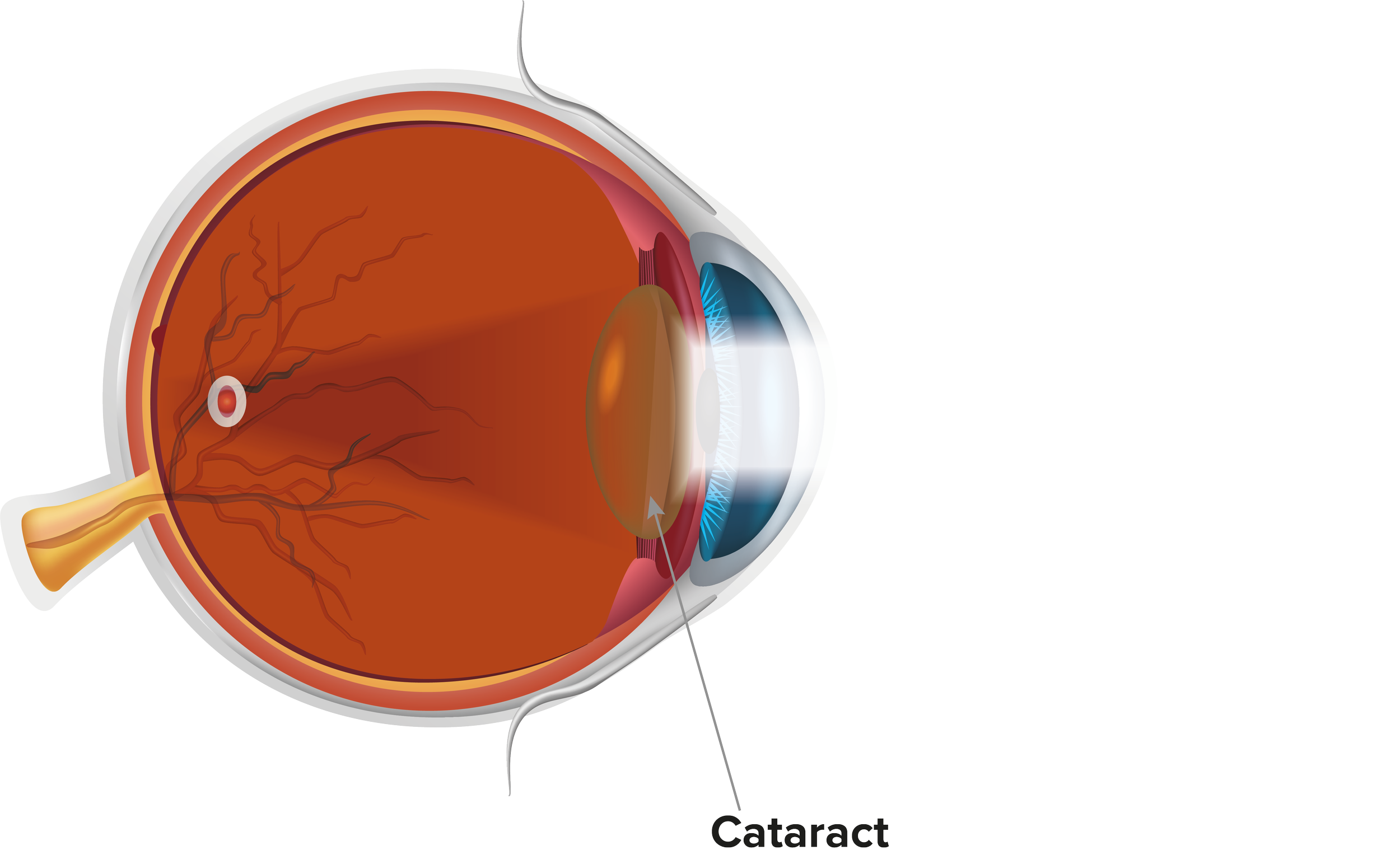 Cataract surgery — Kieren Darcy · Ophthalmologist · Vision Correction ...