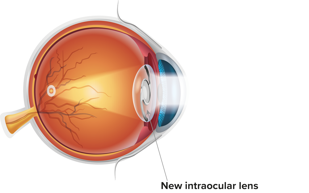 Lens Replacement Surgery — Kieren Darcy · Ophthalmologist · Vision ...