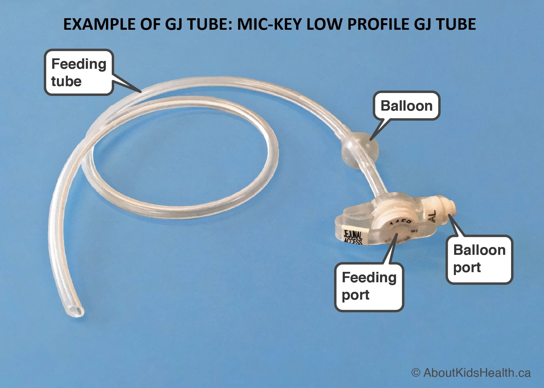 HINT Do You Know What Type Of Enteral Feeding Tube The Child Has HINT Do You Know What Type Of Enteral Feeding Tube The Child Has