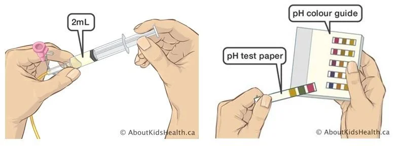 HINT: What to do when you cannot obtain aspirate from a nasogastric (NG) tube to confirm ...