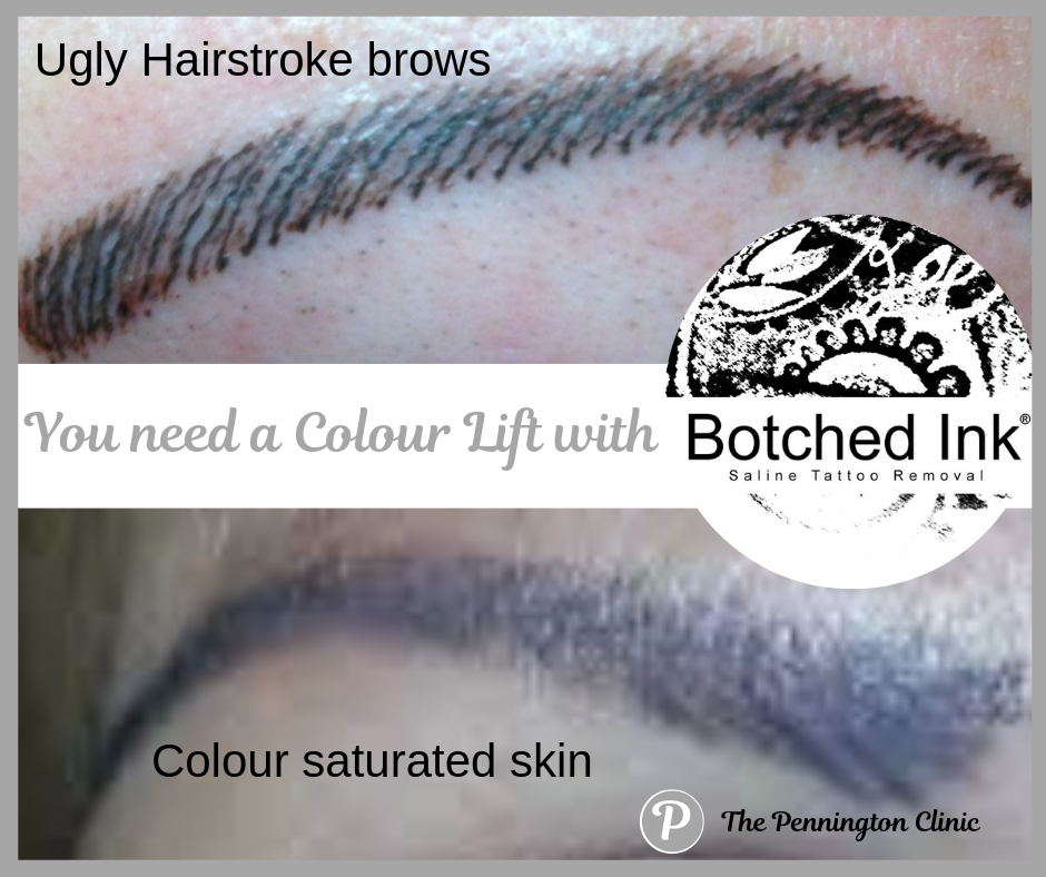 Removal of tattoo eyebrows or lip tattoo. Botched Ink saline removal ...