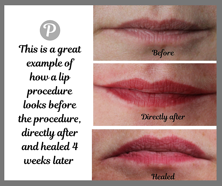 Permanent (tattooed) lip colour for definition — The Pennington Clinic ...
