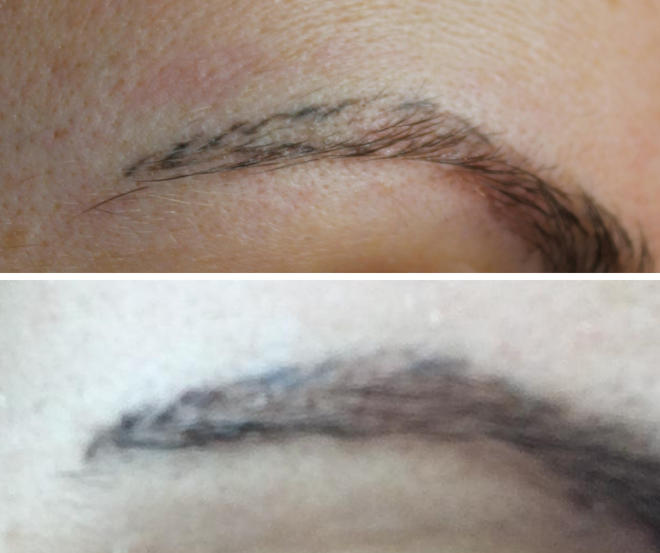 Removal of tattoo eyebrows or lip tattoo. Botched Ink saline removal ...