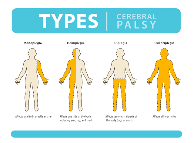 Types Of Cerebral Palsy Brain