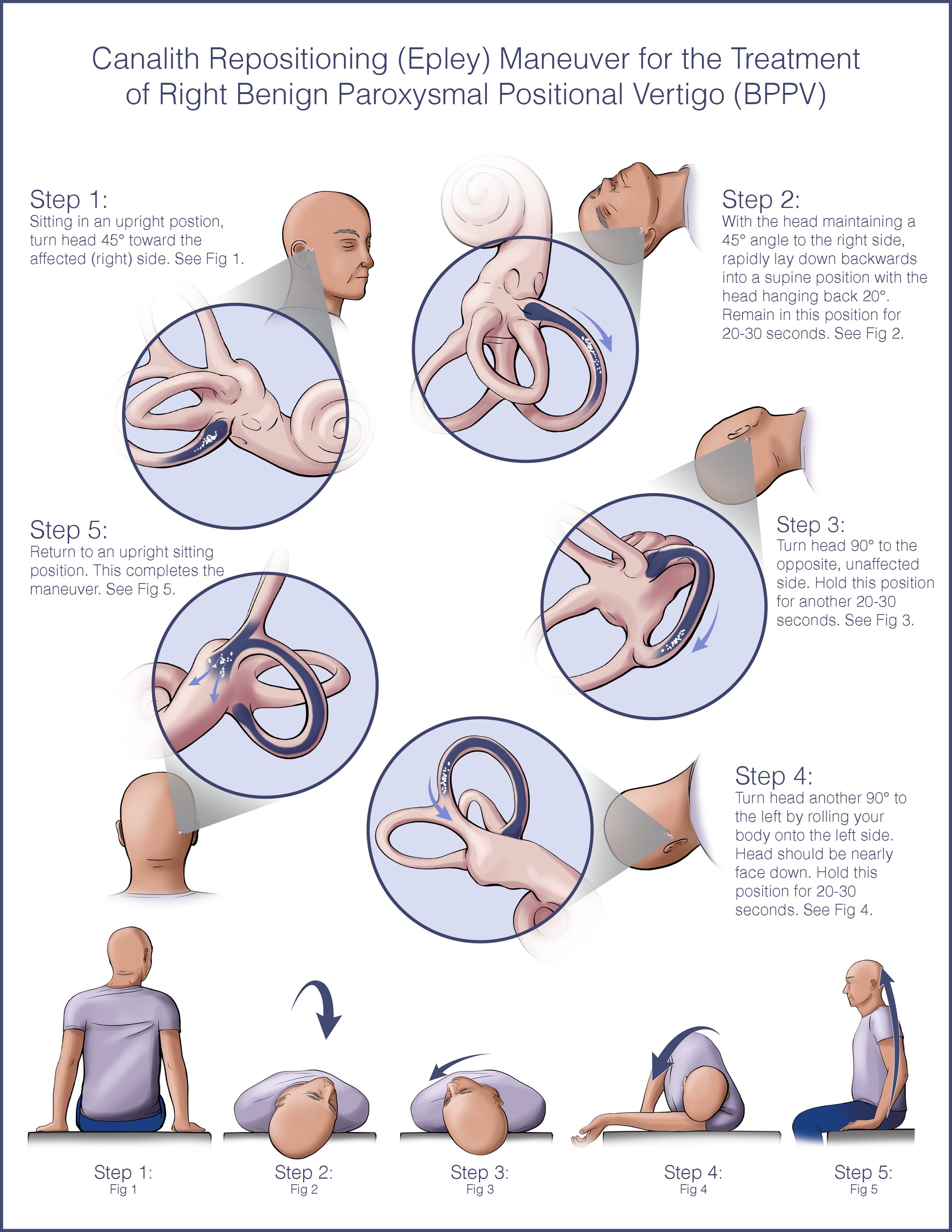 Epley Maneuver for the Treatment of Right BPPV — JEREMY MILLER, CMI