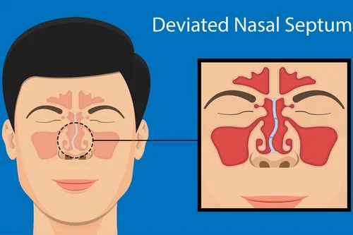 The Details to Emphasize About Deviated Nasal Septum Surgery