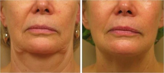 Skin Resurfacing | Laser Rejuvenation In Calgary — Britannia Dermedics