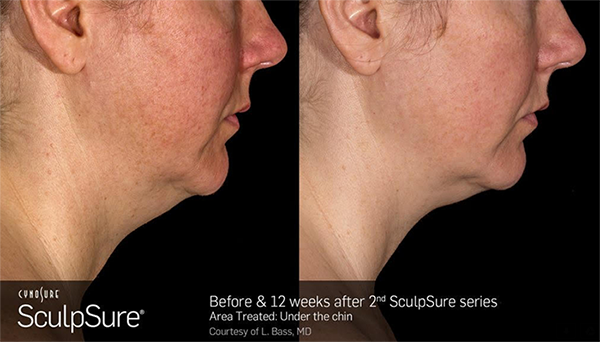 Double-Chin & SculpSure Submental Treatments In Calgary — Britannia ...