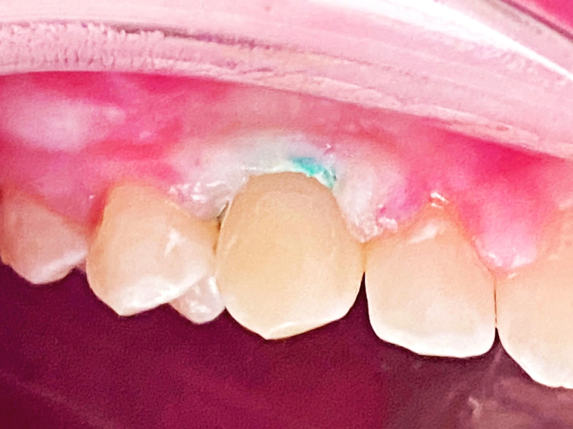 tooth-colored-fillings