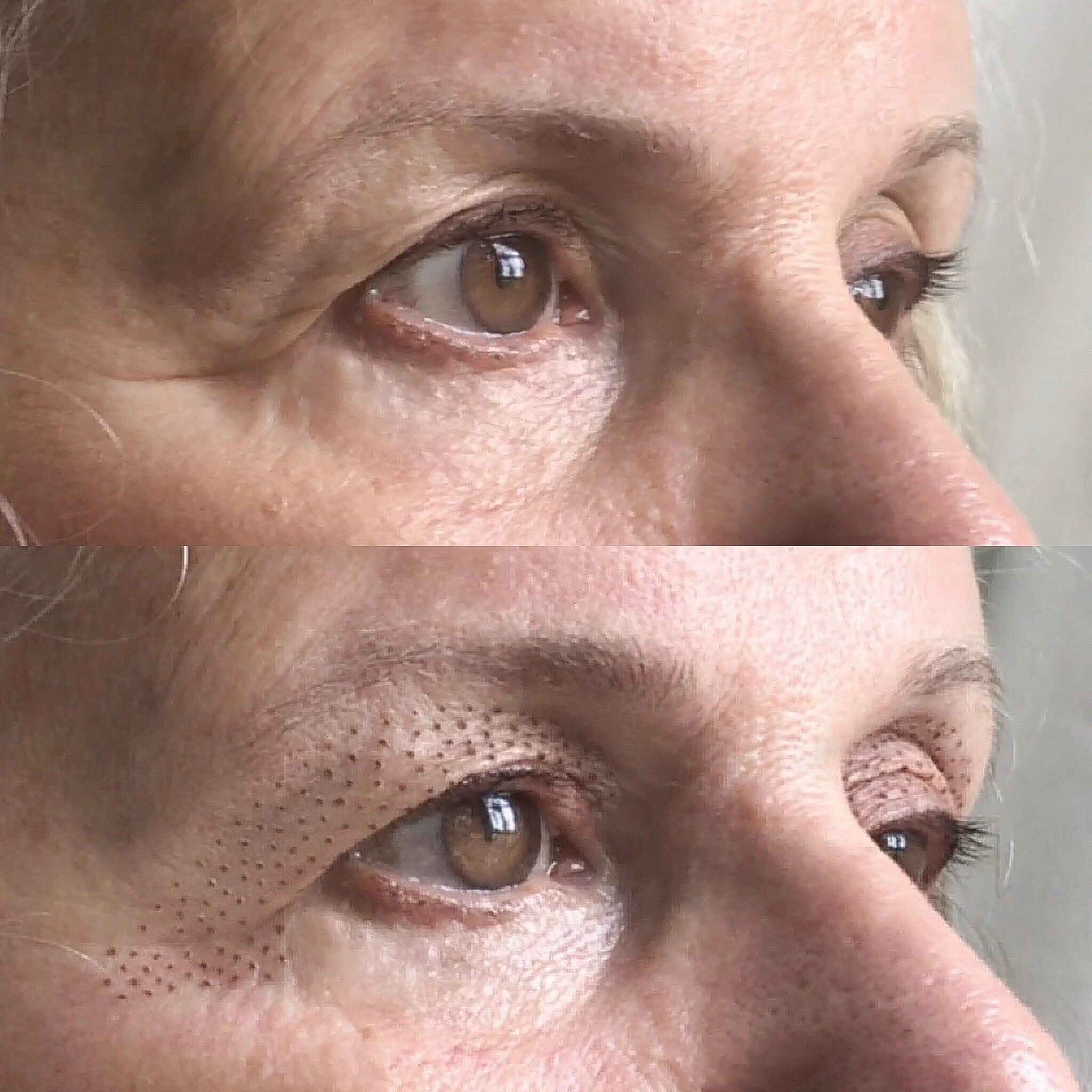 Plasma Lift Skin Tightening — Proud brow