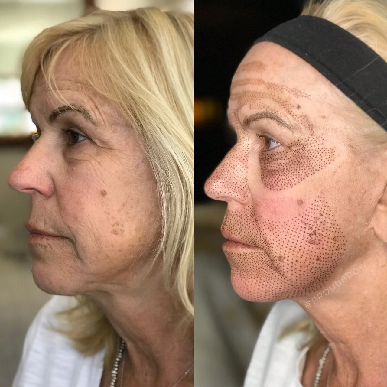 Plasma Lift Skin Tightening — Proud brow