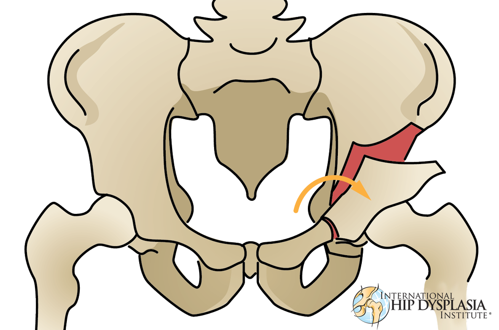 Bekkenosteotomie — Orthokliniek