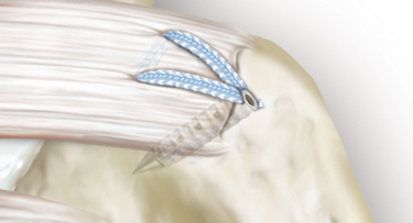 Rotator cuff letsels — Orthokliniek