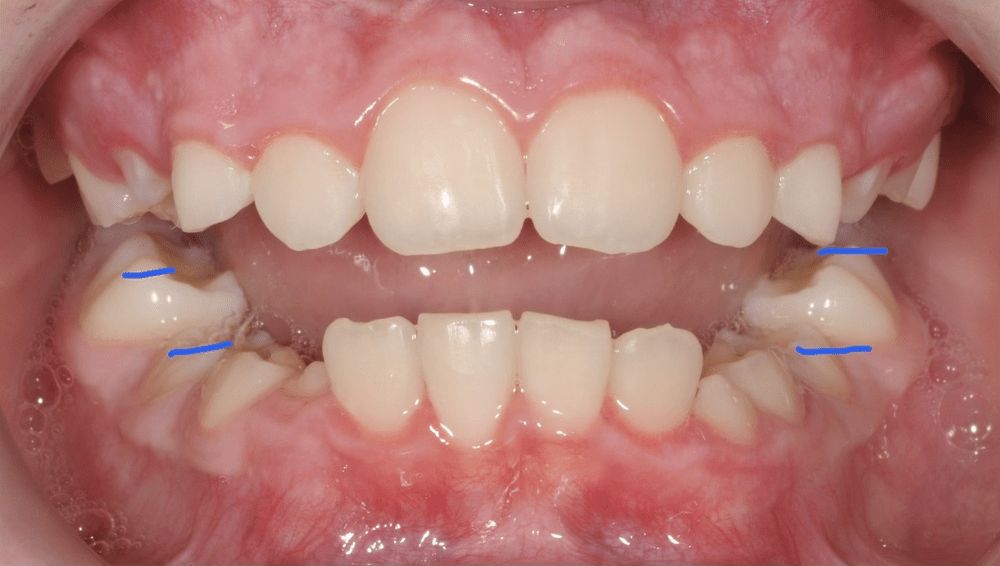 What is Ankylosis & Why it’s Important to deal with it — Lemchen Salzer ...