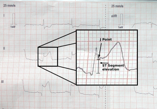 Acute Myocardial Infarction — Paramedic Study Guide | Ultimate study ...