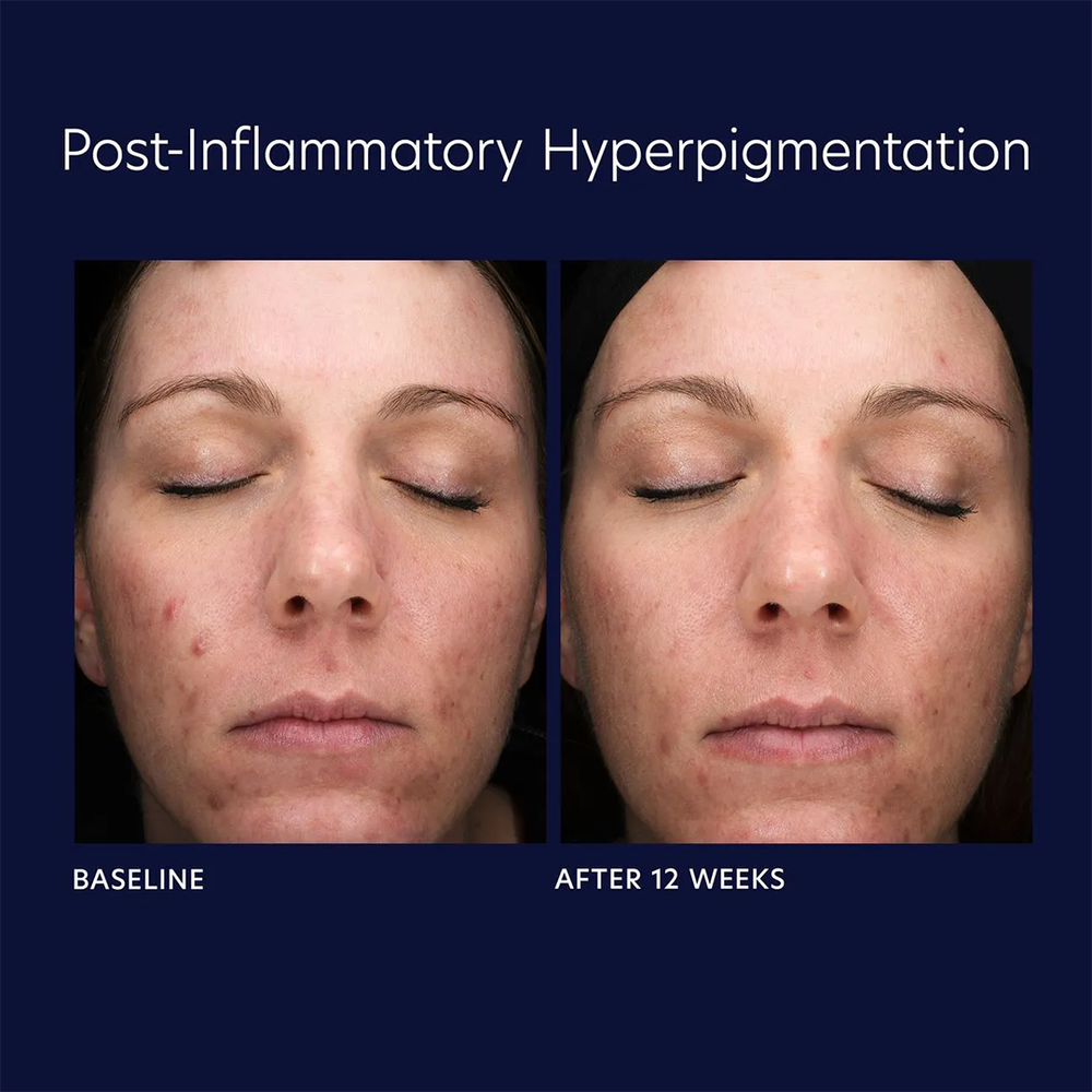 Pigment Correct Peel | Hyperpigmentation Peel |Skin-Sational Medical ...