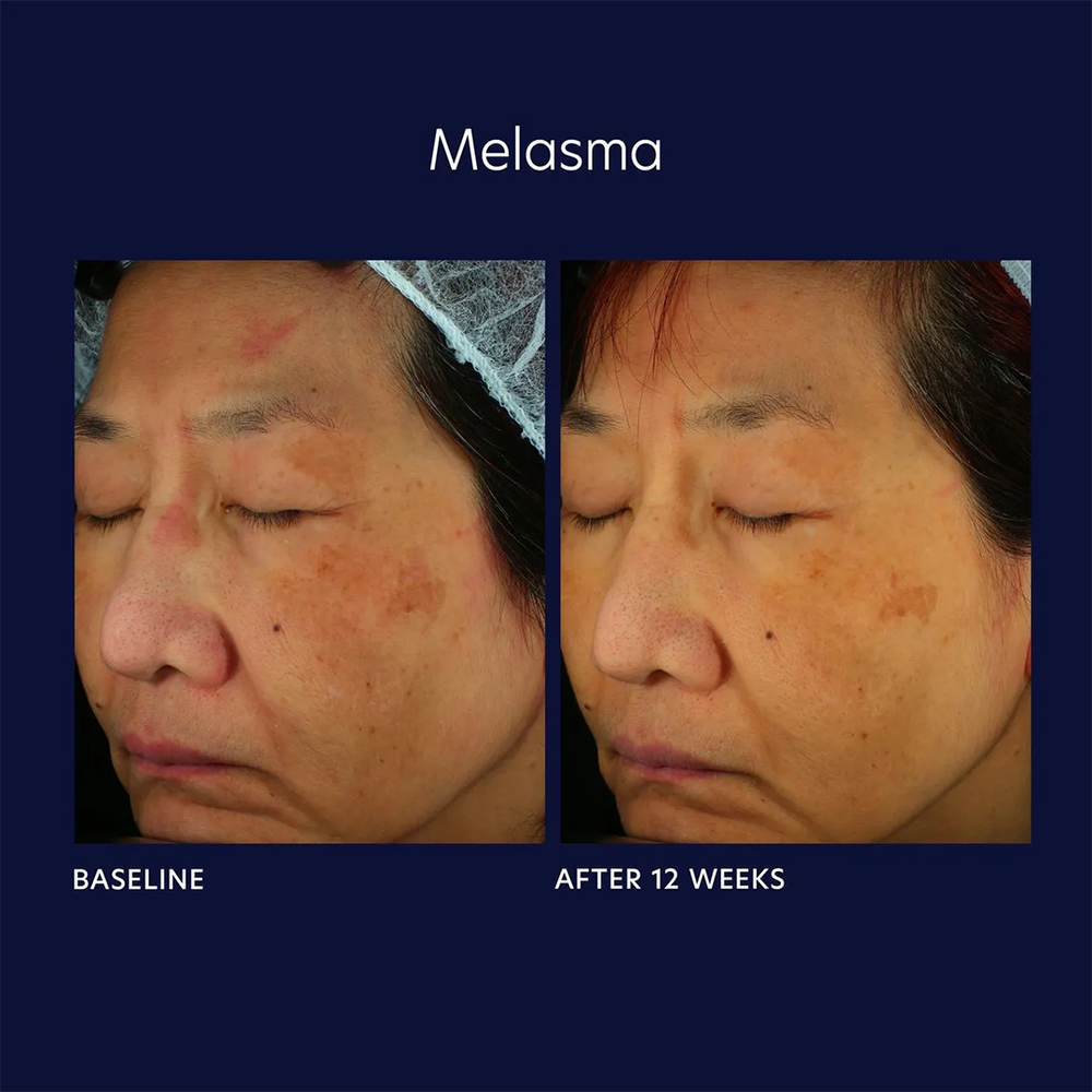 Pigment Correct Peel | Hyperpigmentation Peel |Skin-Sational Medical ...