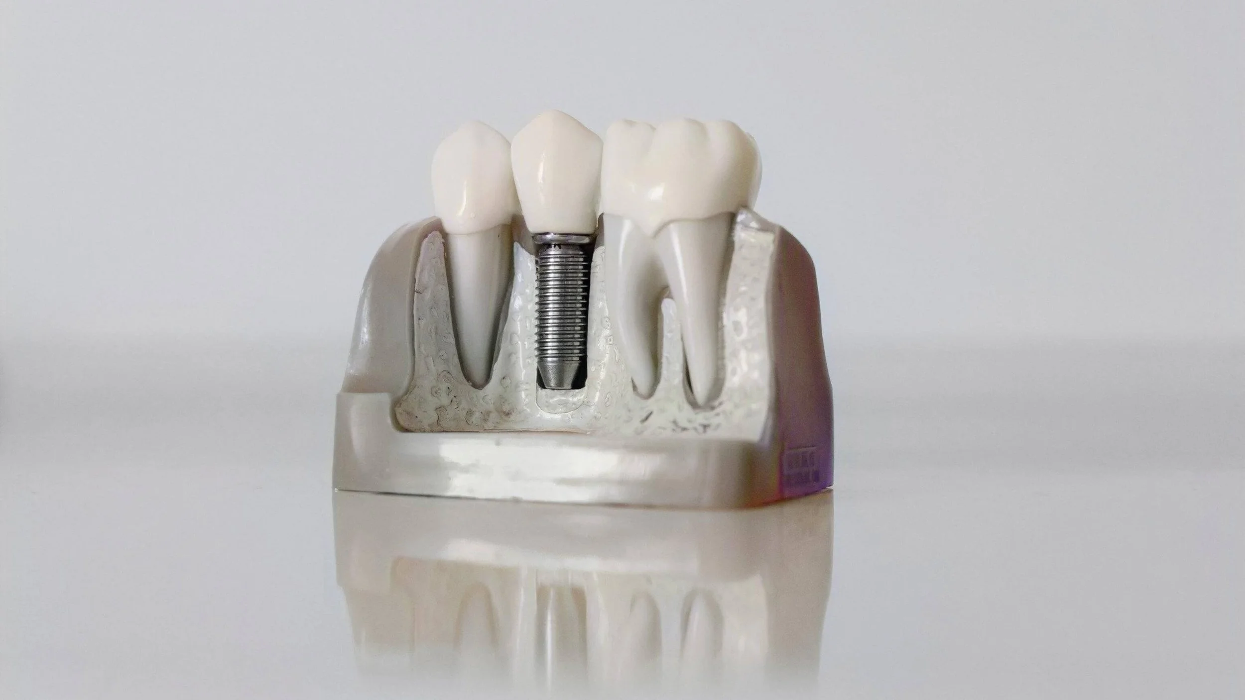 Implants | Sedation Dentistry | Lake Harbor Dental