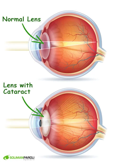 What is a Cataract? — Soliman Paroli Eyecare