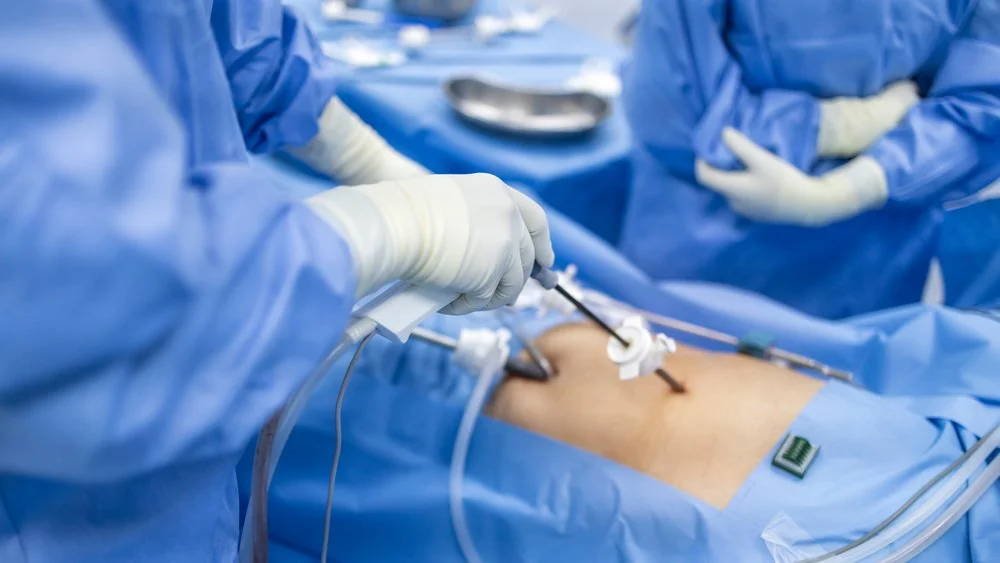 Acessa™ Procedure versus Uterine Fibroid Embolization (UFE) — The ...