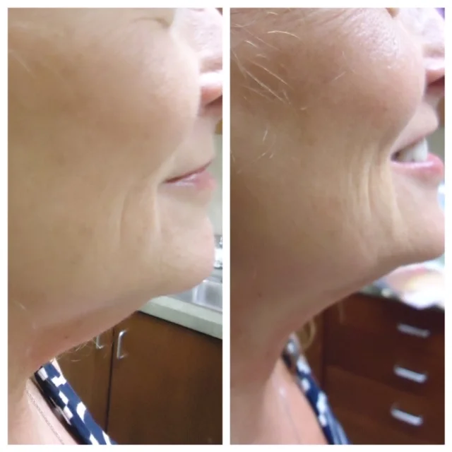 Double Chin Treatments — ACE Dermatology, Laser and Cosmetics