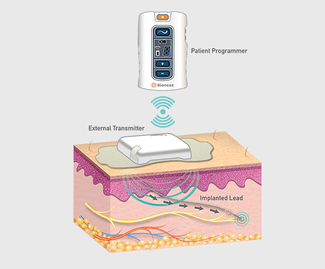 Peripheral Nerve Stimulation Pain Treatment in Tampa, Florida — TampaPainMD