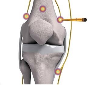 Knee Pain Specialist in Tampa, FL — TampaPainMD